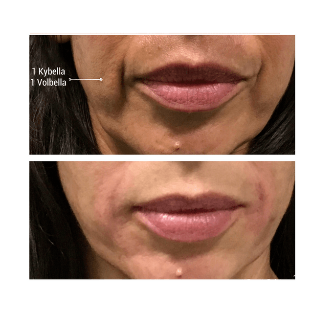 Kybella On The Face – Botox, Med Spa – Artistic Touch Advanced ...
